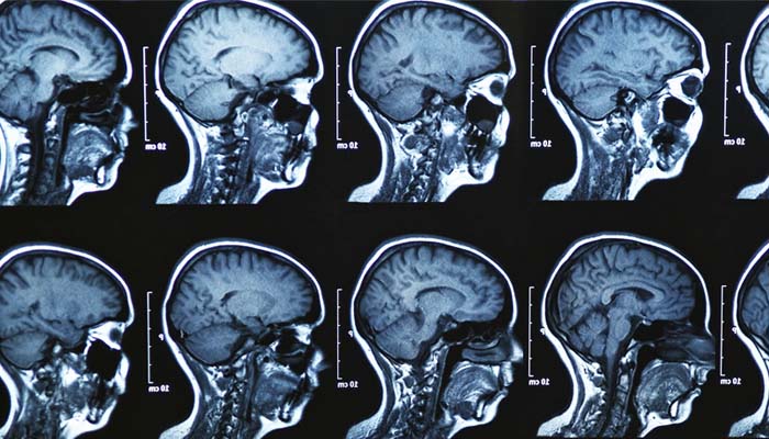New approach lets neurosurgeons map the brain faster, cheaper – WashU ...
