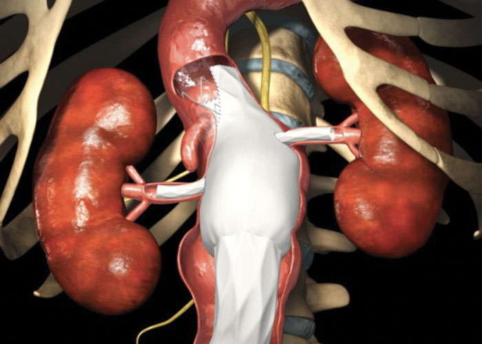 Testing branched devices to fix iliac aneurysms – WashU Medicine