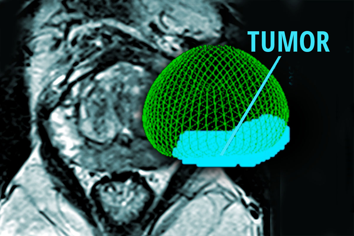 Study finds marker of aggressive prostate cancer – WashU Medicine