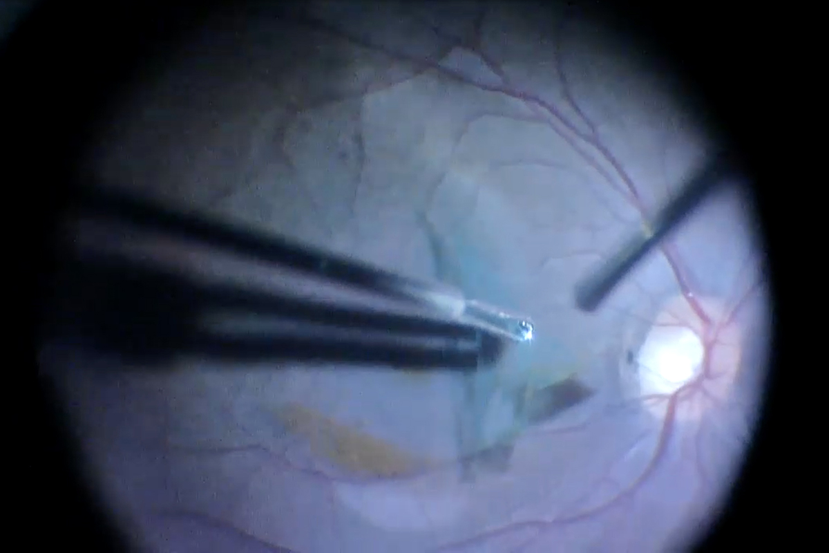 Surgery, even if delayed, can restore vision in patients with brain ...