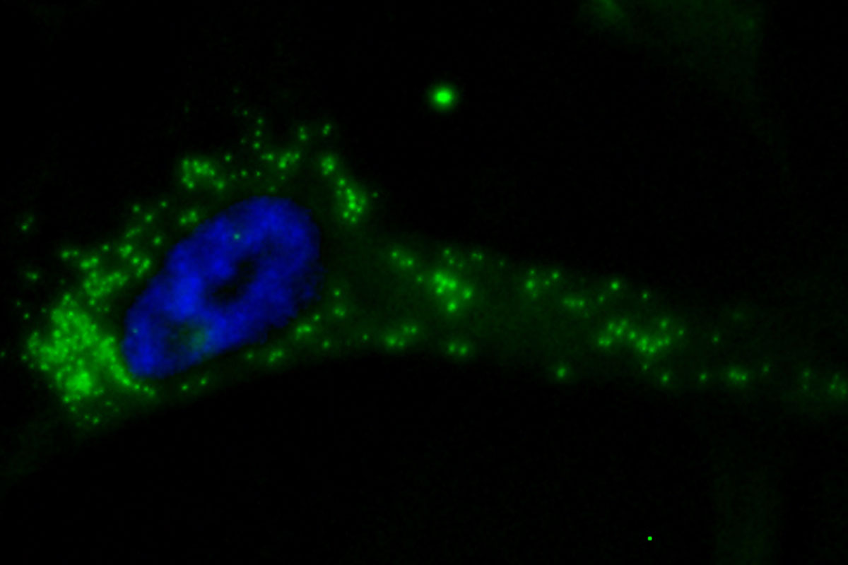 Study unveils new way to starve tumors to death – WashU Medicine