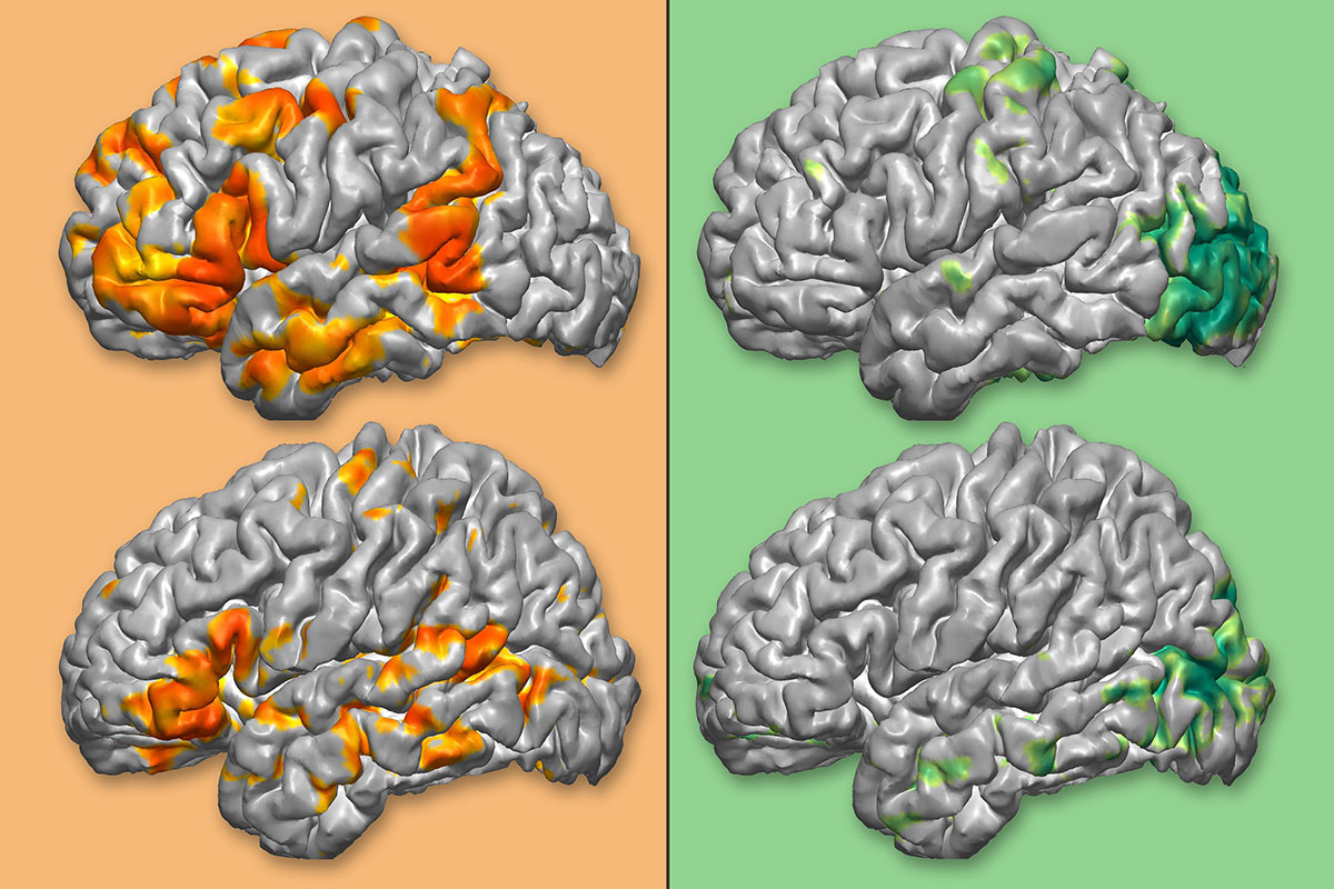 $3.6 million to fund personalized 3-D brain maps to guide ...