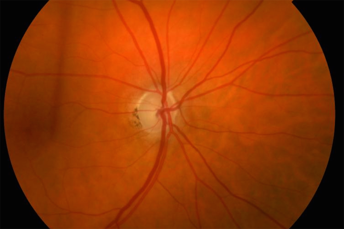 Potential predictor of glaucoma damage identified – WashU Medicine