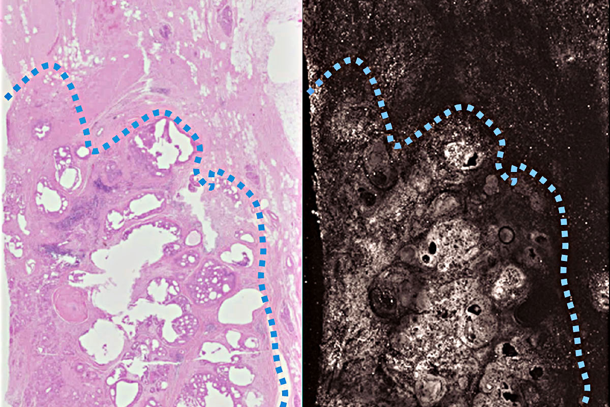 New imaging technique aims to ensure surgeons completely remove cancer ...