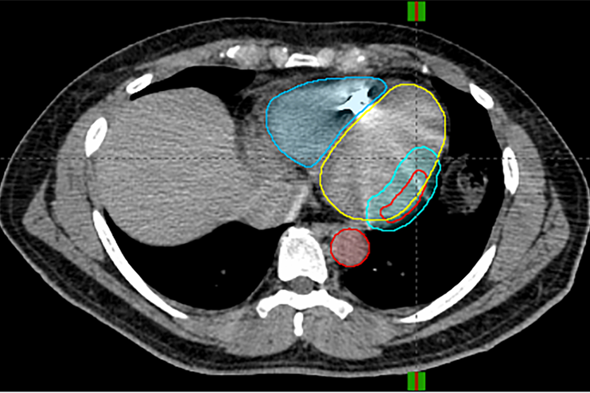 Deadly heart rhythm halted by noninvasive radiation therapy – WashU ...