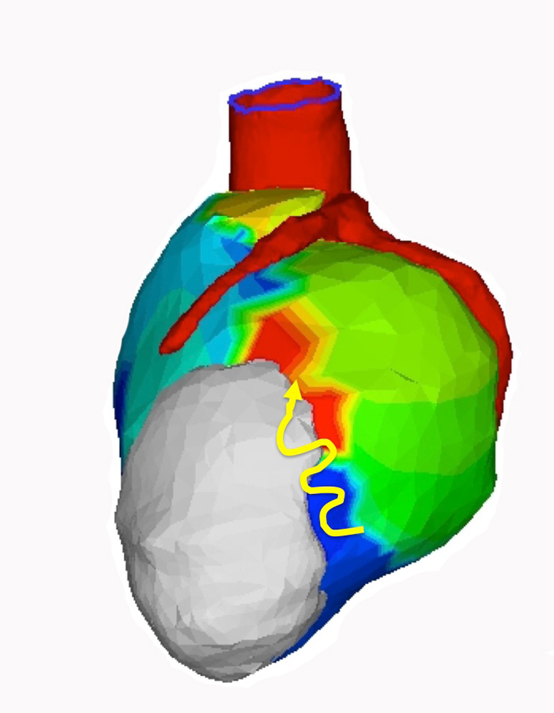 Deadly heart rhythm halted by noninvasive radiation therapy – WashU ...