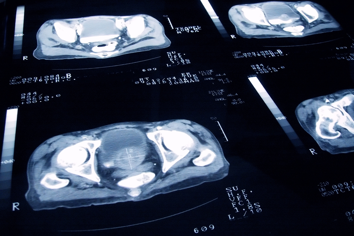 Analysis of prostate tumors reveals clues to cancer’s aggressiveness ...