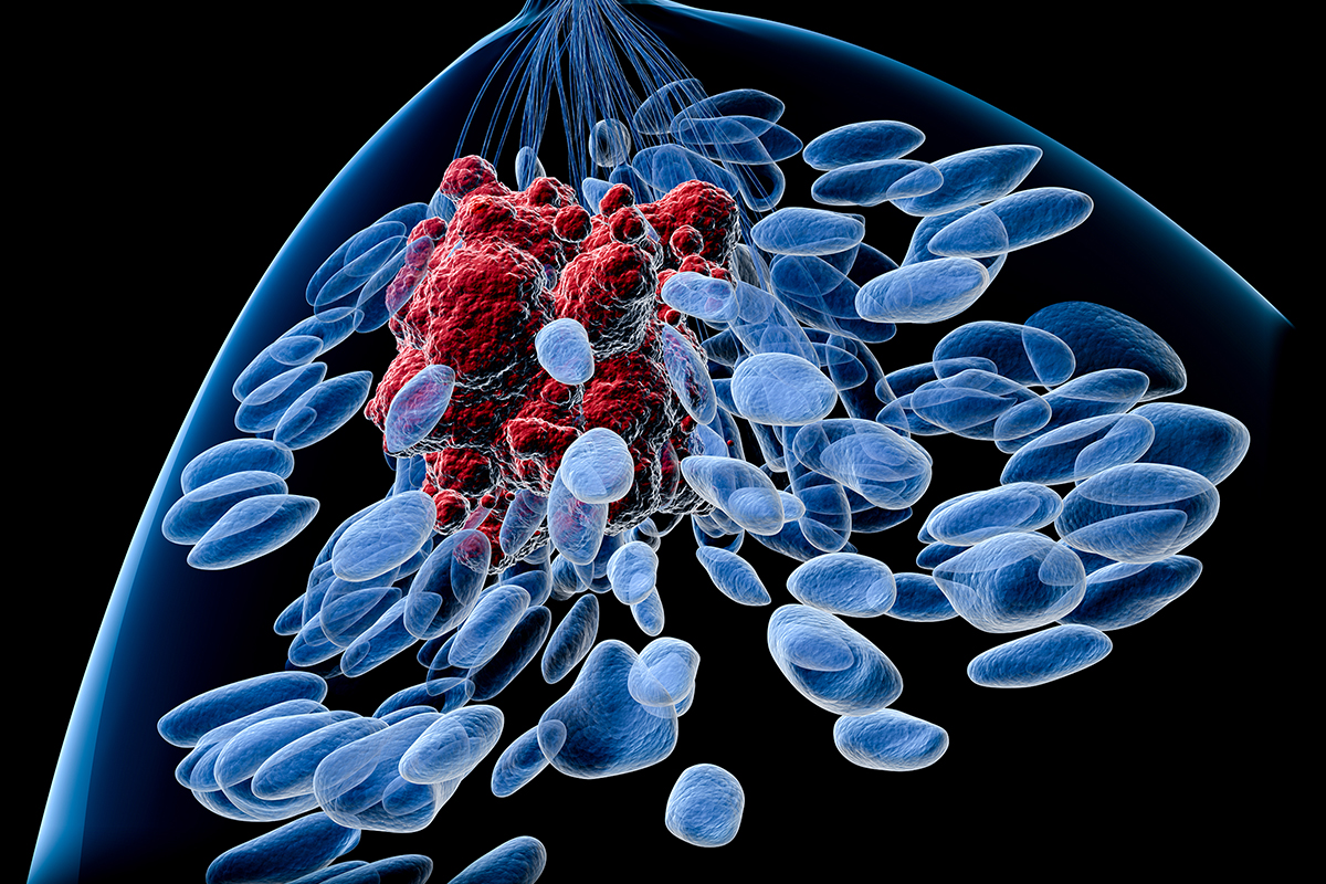 New clues found to understanding relapse in breast cancer – WashU Medicine