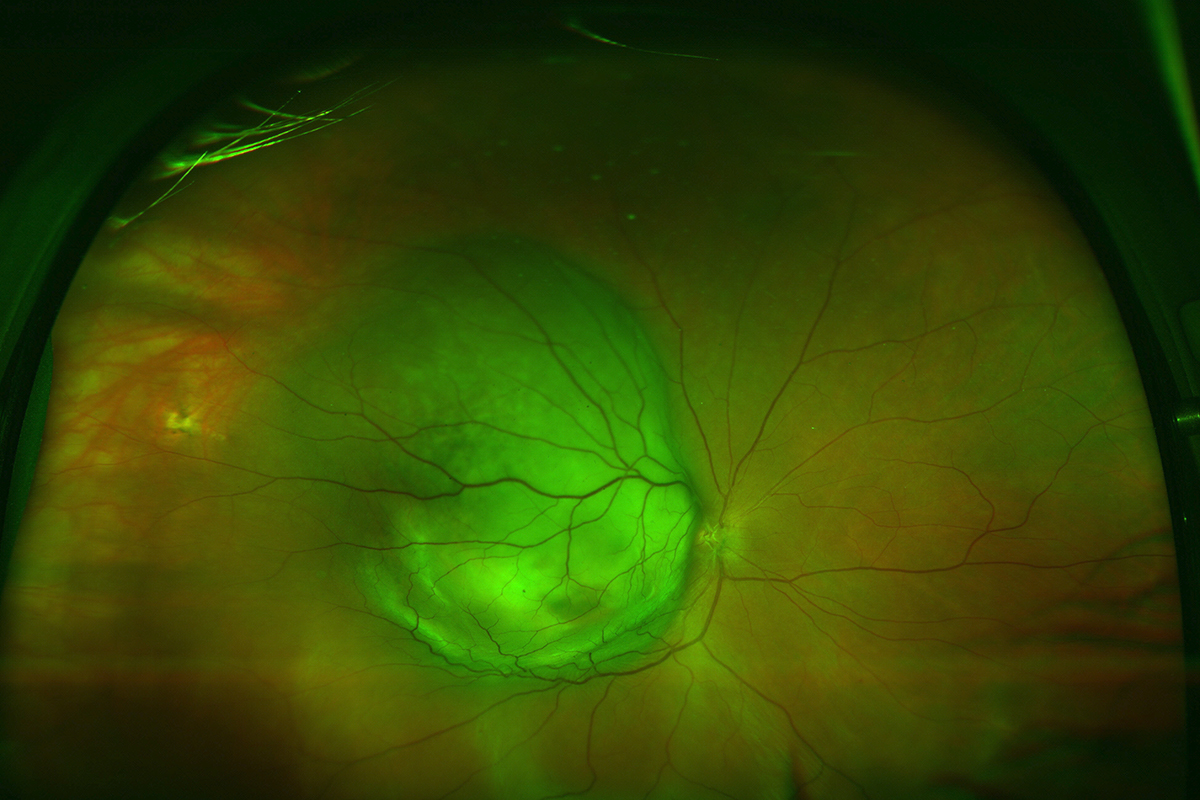 Scientists identify weak point in deadly eye melanoma – WashU Medicine