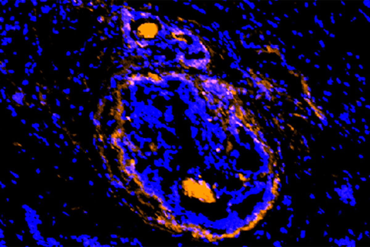 Cancerous tumors, surrounding cells illuminated by new imaging agent ...