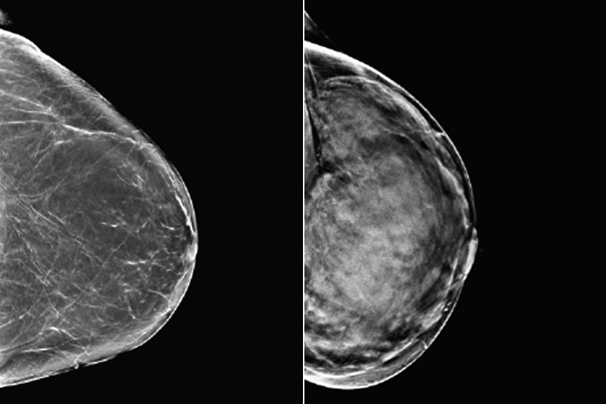 Algorithm analyzes mammograms, signals need for more breast cancer ...