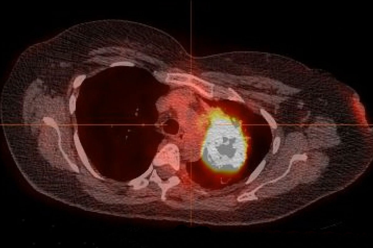 Most cases of never-smokers’ lung cancer treatable with mutation ...