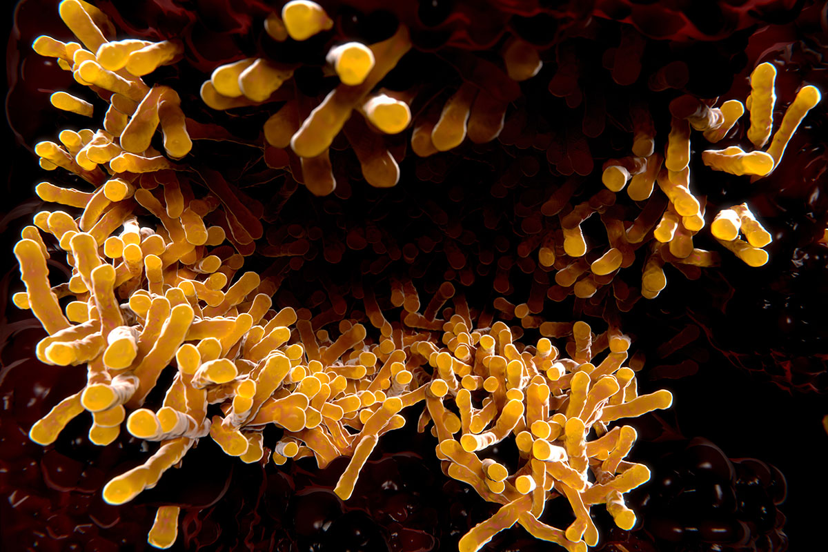 Possible new method identified to assess severity of TB infection ...