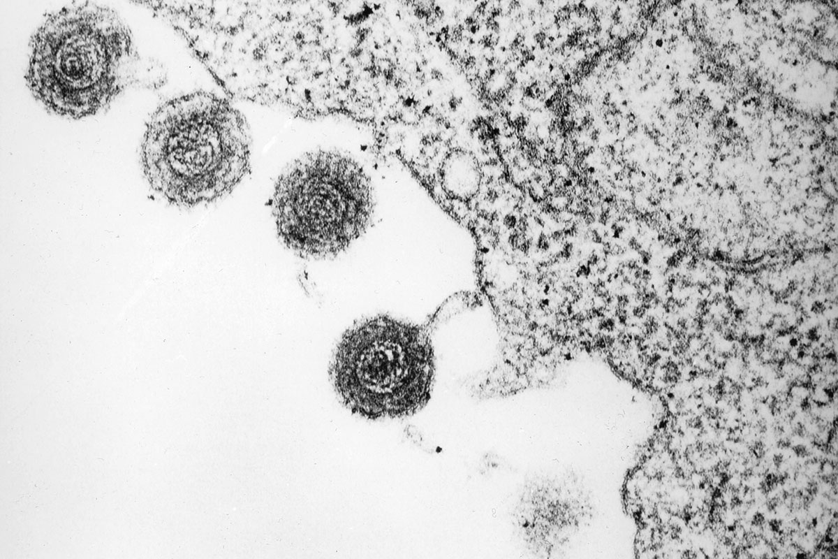 New way viruses trigger autoimmunity discovered – WashU Medicine