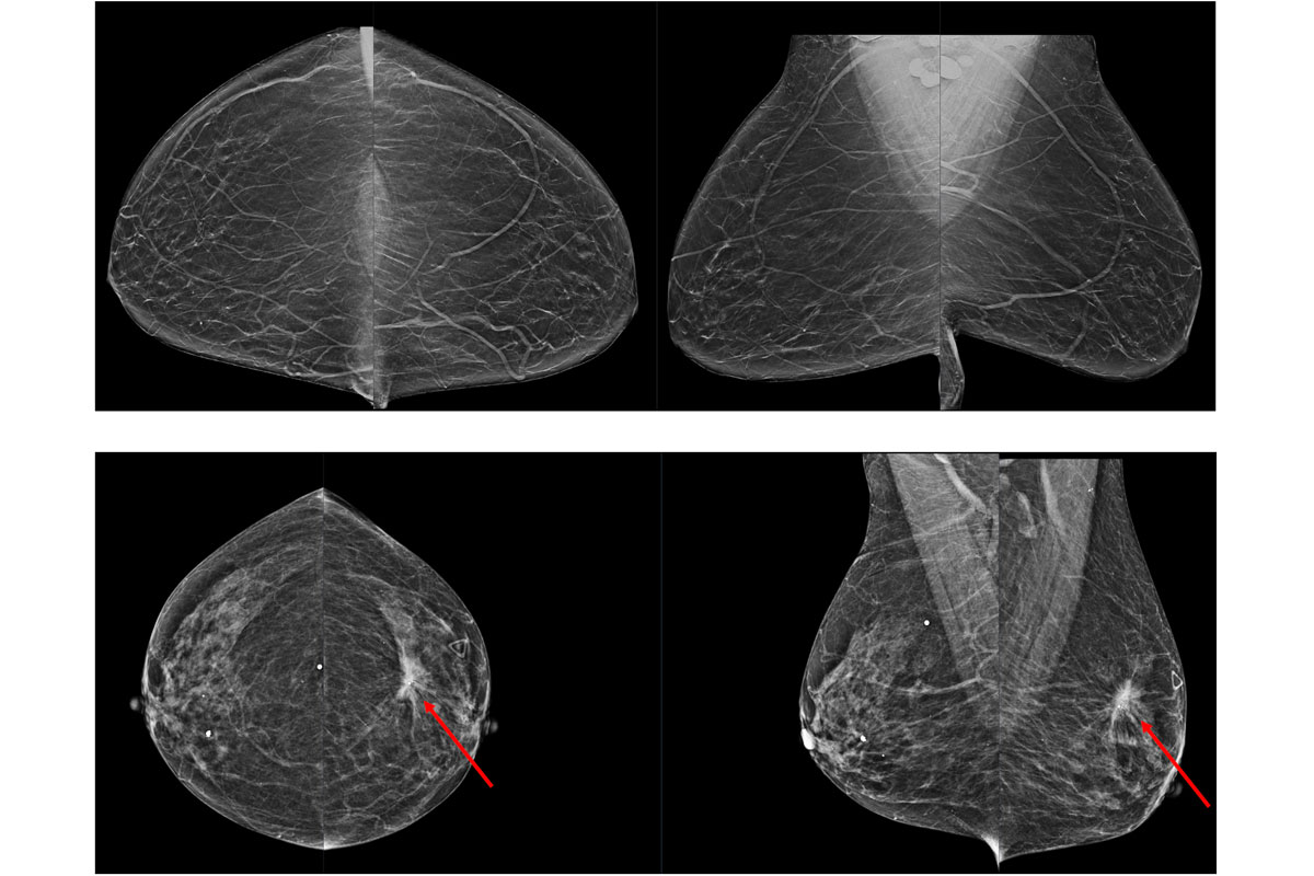 Healthy Mammogram Results Breast (Chest) Density Information For
