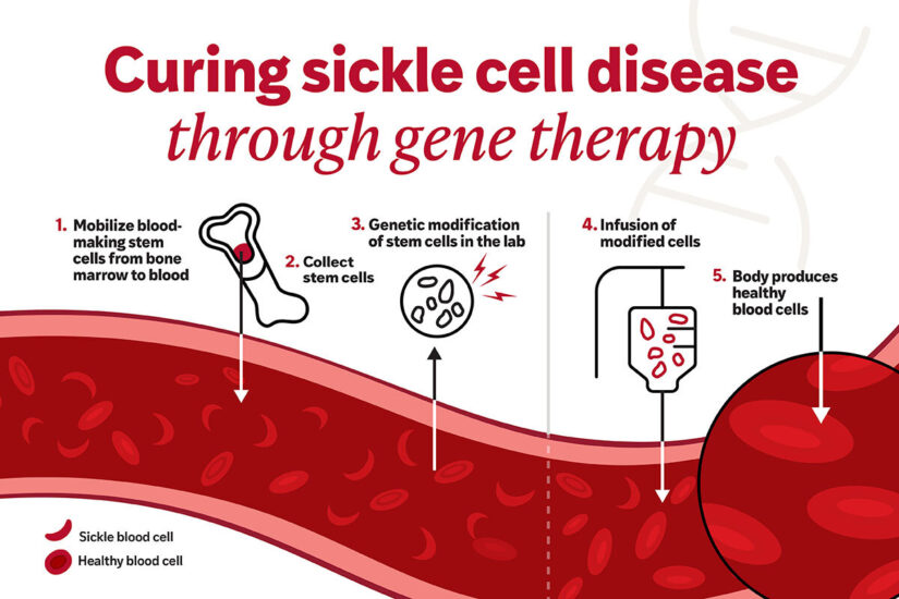 Region’s first patient receives sickle cell gene therapy – WashU Medicine