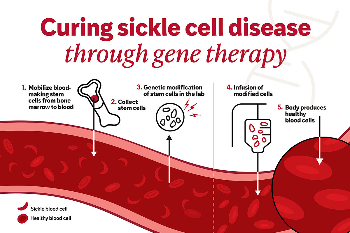 Region’s first patient receives sickle cell gene therapy – WashU Medicine